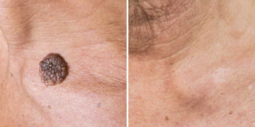 PLEXR® Plus Plasma Technology – One Planet Aesthetics